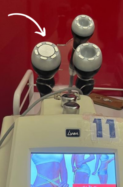 An honest review of London Weight Management’s ezSlim™ Treatment